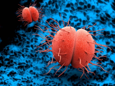 Gonorrhea (tripper)